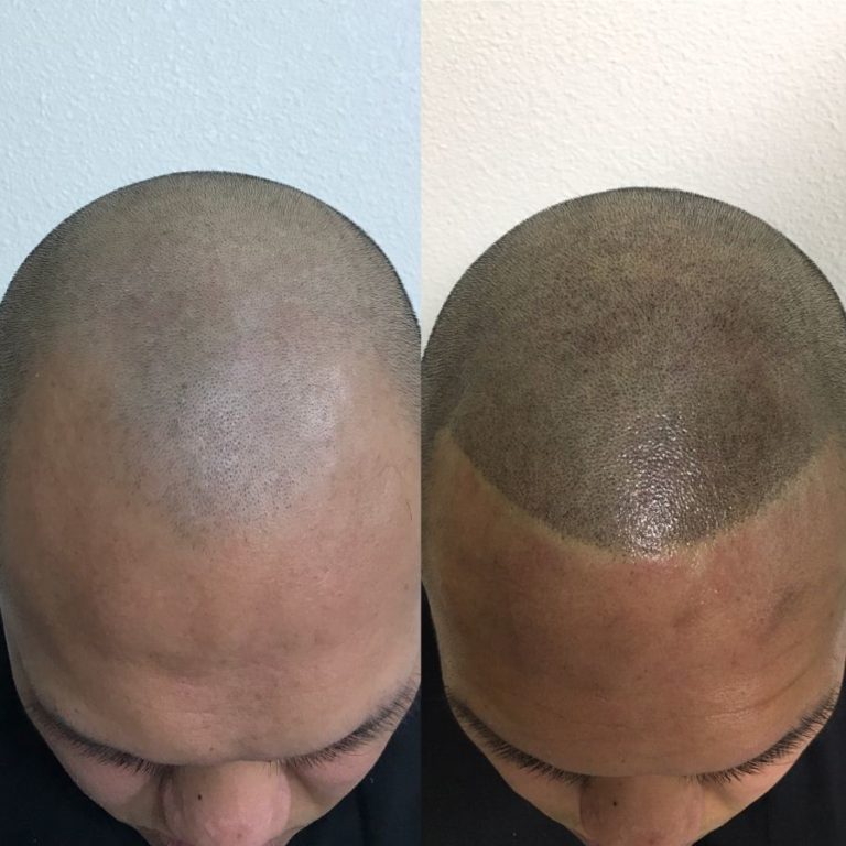 What is SMP - Scalp Micropigmentation - FULL Micropigmentation