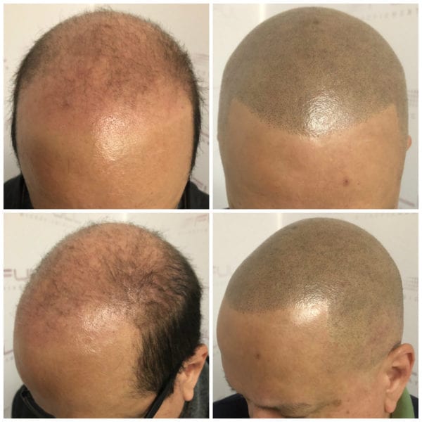 Carlos Before and After Square - FULL Micropigmentation