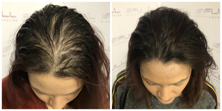 Scalp Micropigmentation For Women - FULL Micropigmentation