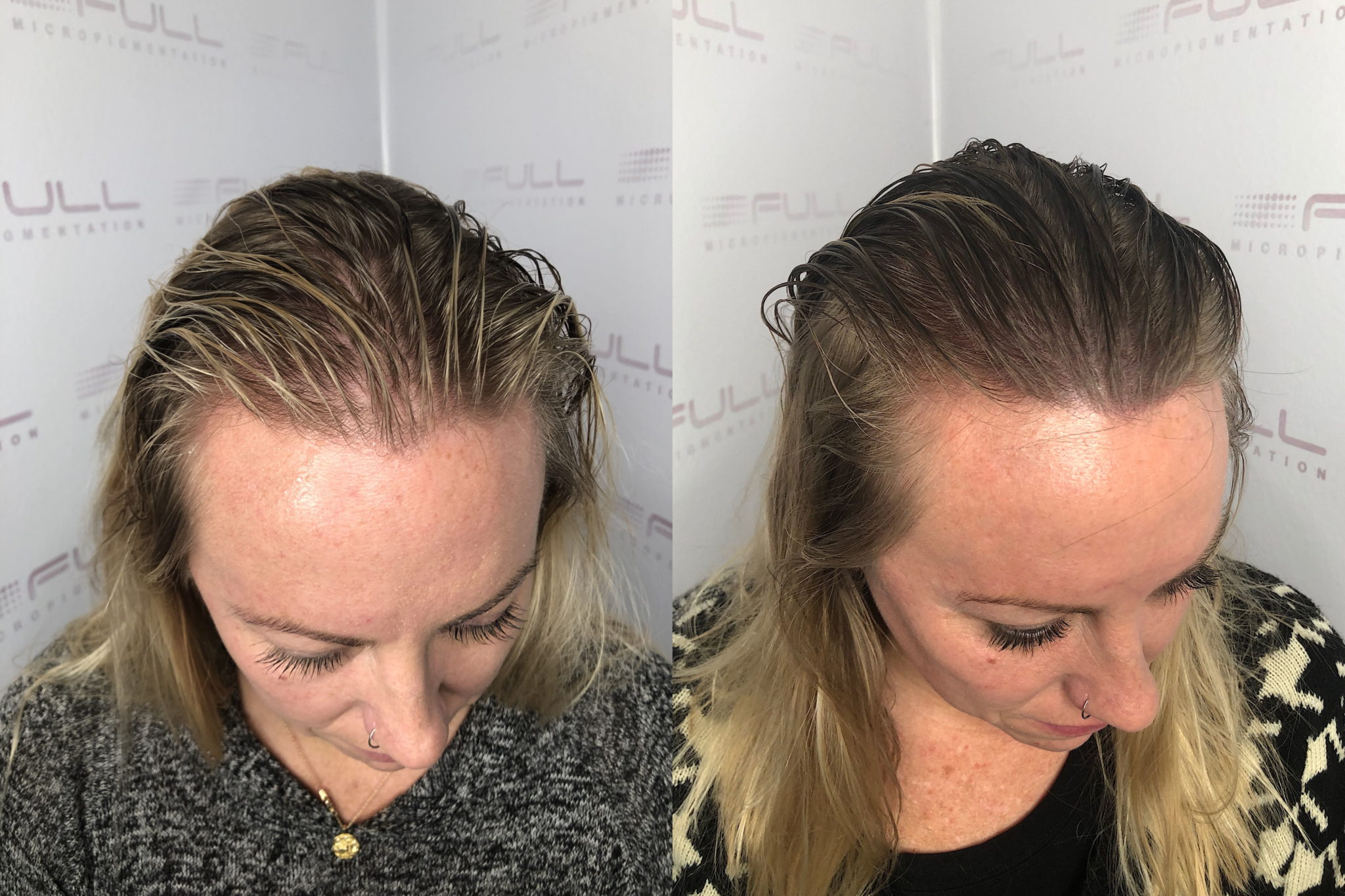 Scalp Micropigmentation For Women - FULL Micropigmentation