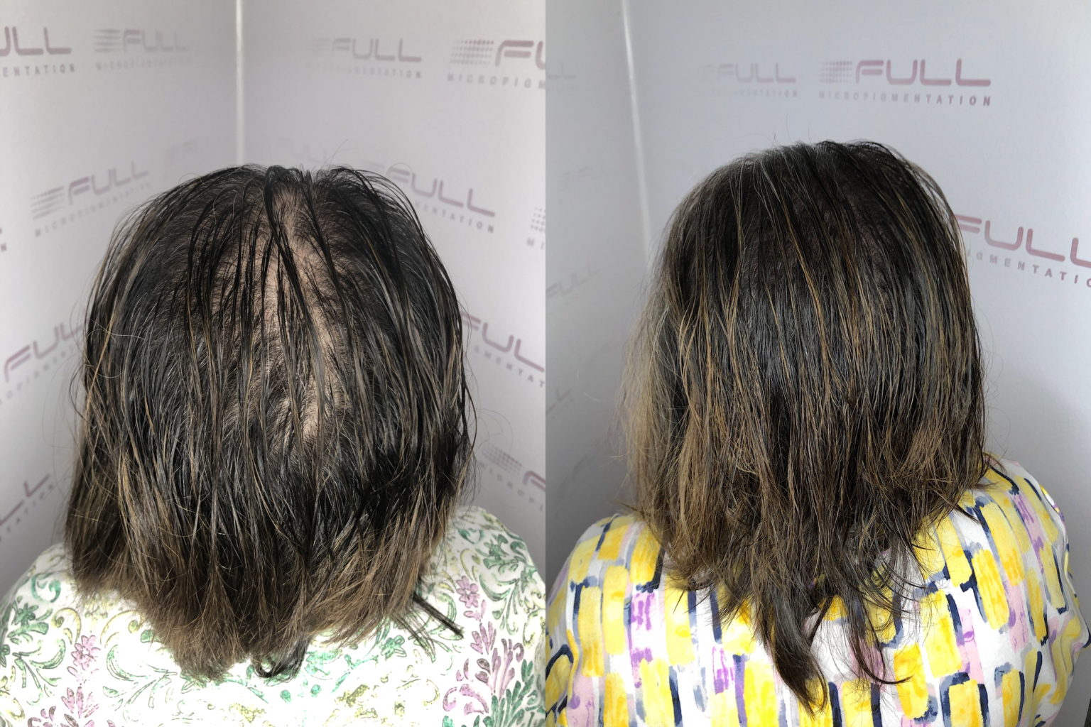 Scalp Micropigmentation For Women - FULL Micropigmentation