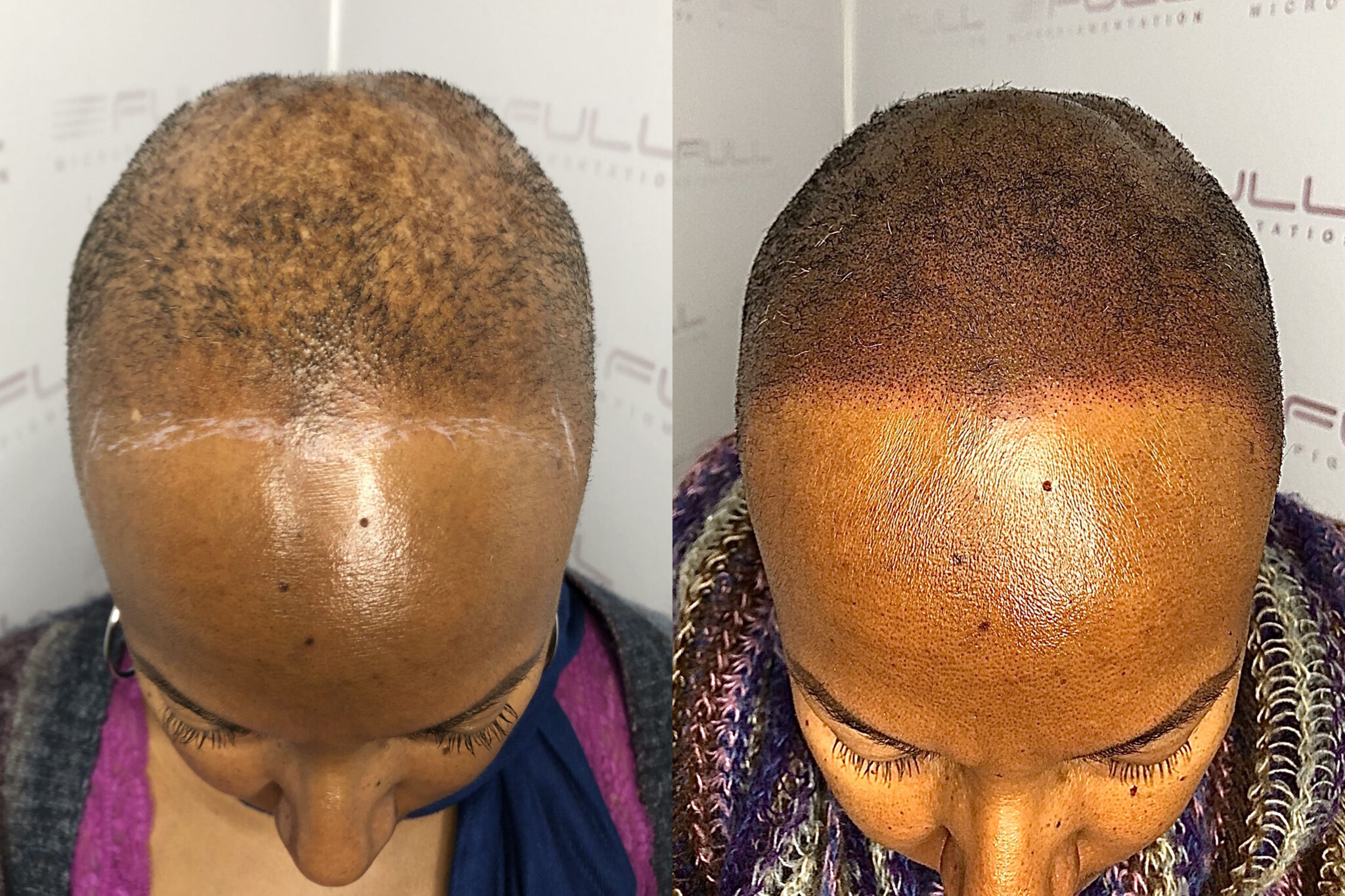 Scalp Micropigmentation For Women - FULL Micropigmentation