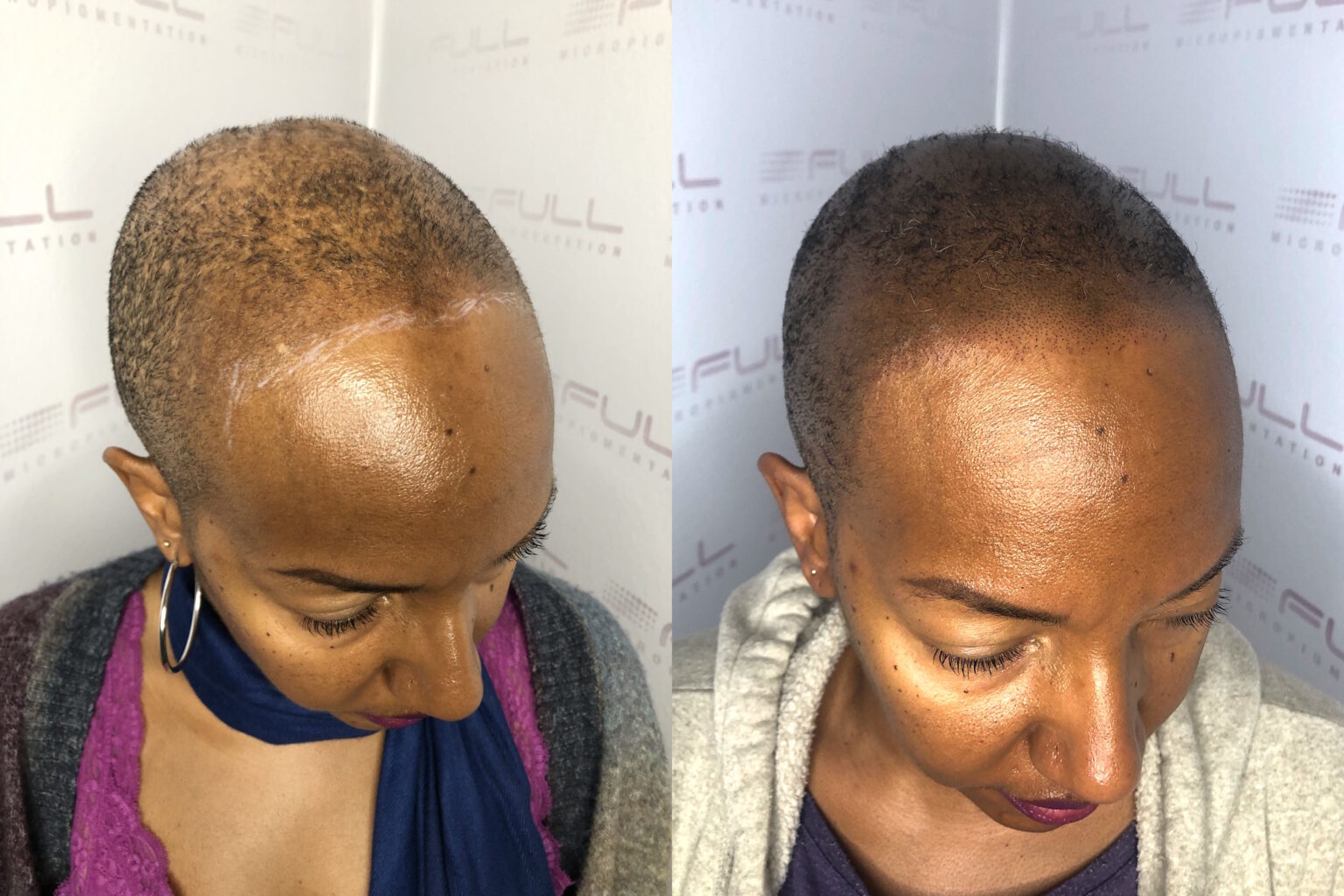 Scalp Micropigmentation For Women - FULL Micropigmentation
