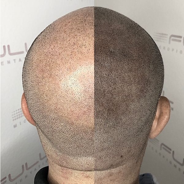 Before and after micropigmentation - FULL Micropigmentation