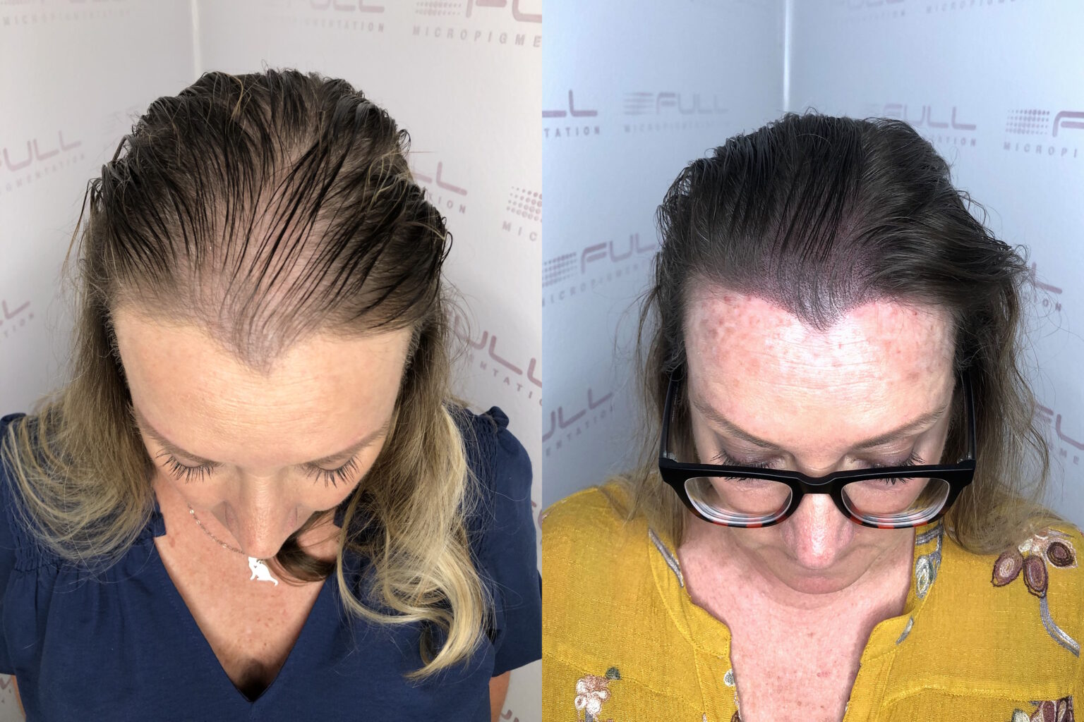 Scalp Micropigmentation For Women - FULL Micropigmentation