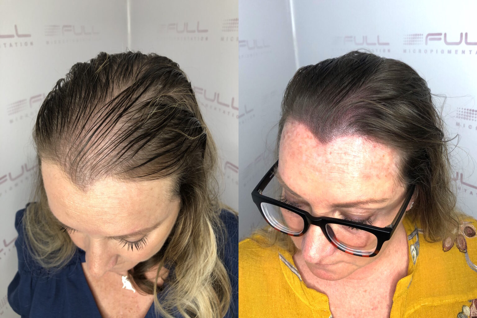 Scalp Micropigmentation For Women - FULL Micropigmentation