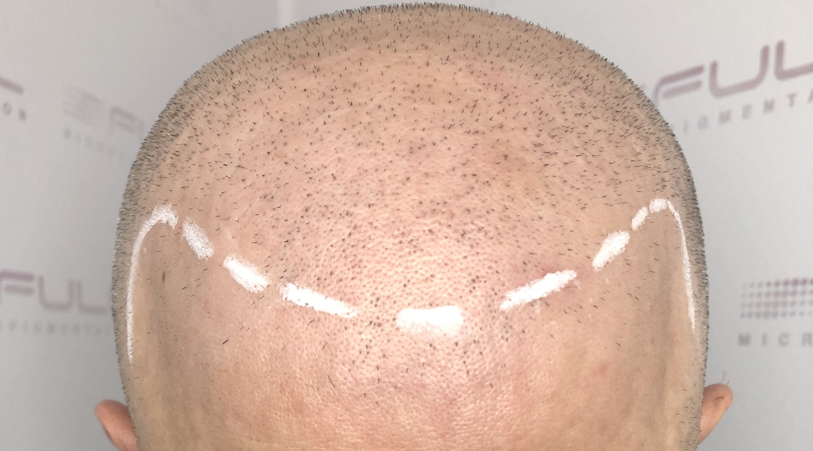 Ed Hi Res 3 - FULL Micropigmentation